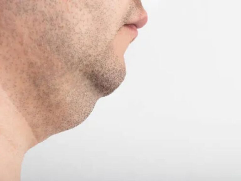 How to Reduce Face Fat and Double Chin Naturally: Tips That Work - PUNE ...