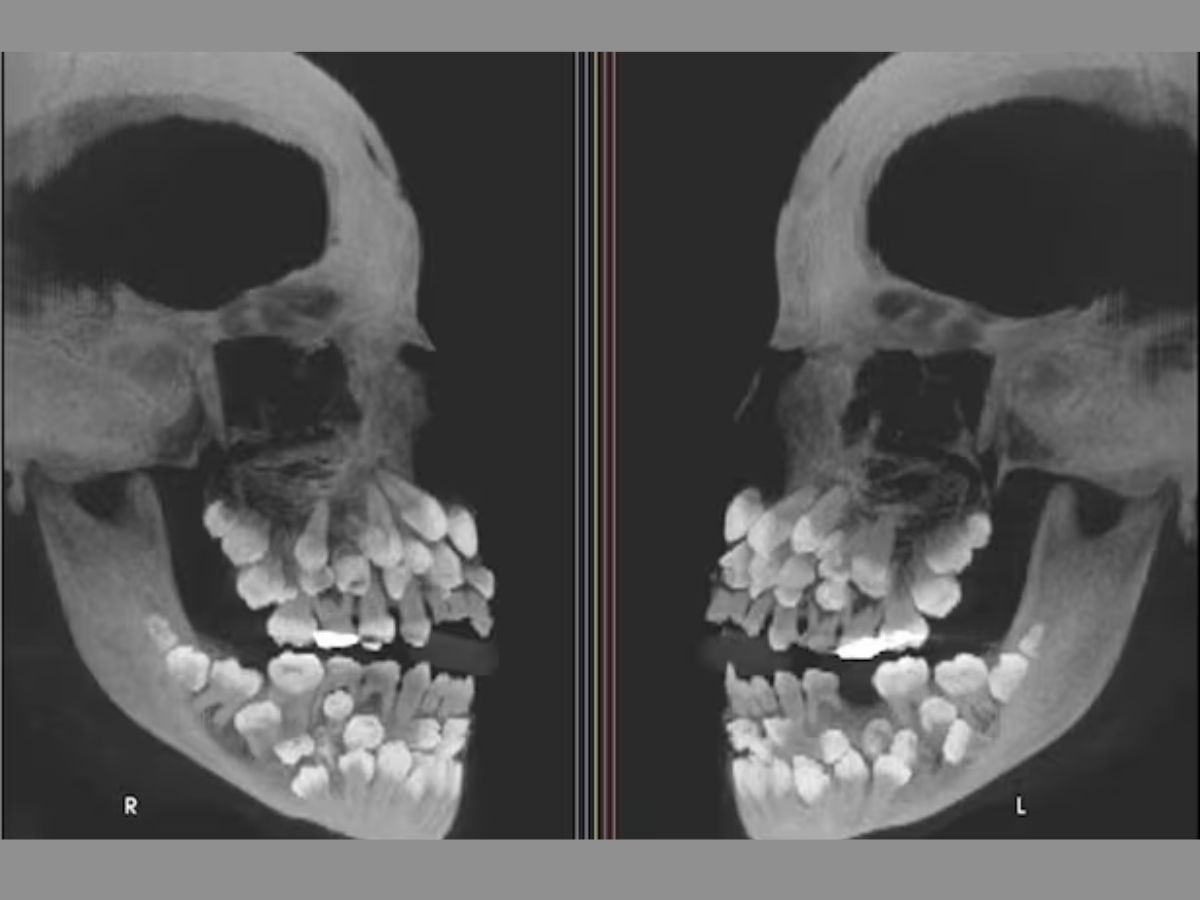 11-Year-Old Girl Stuns Doctors With 81 Teeth — A Rare Condition Seen in ...