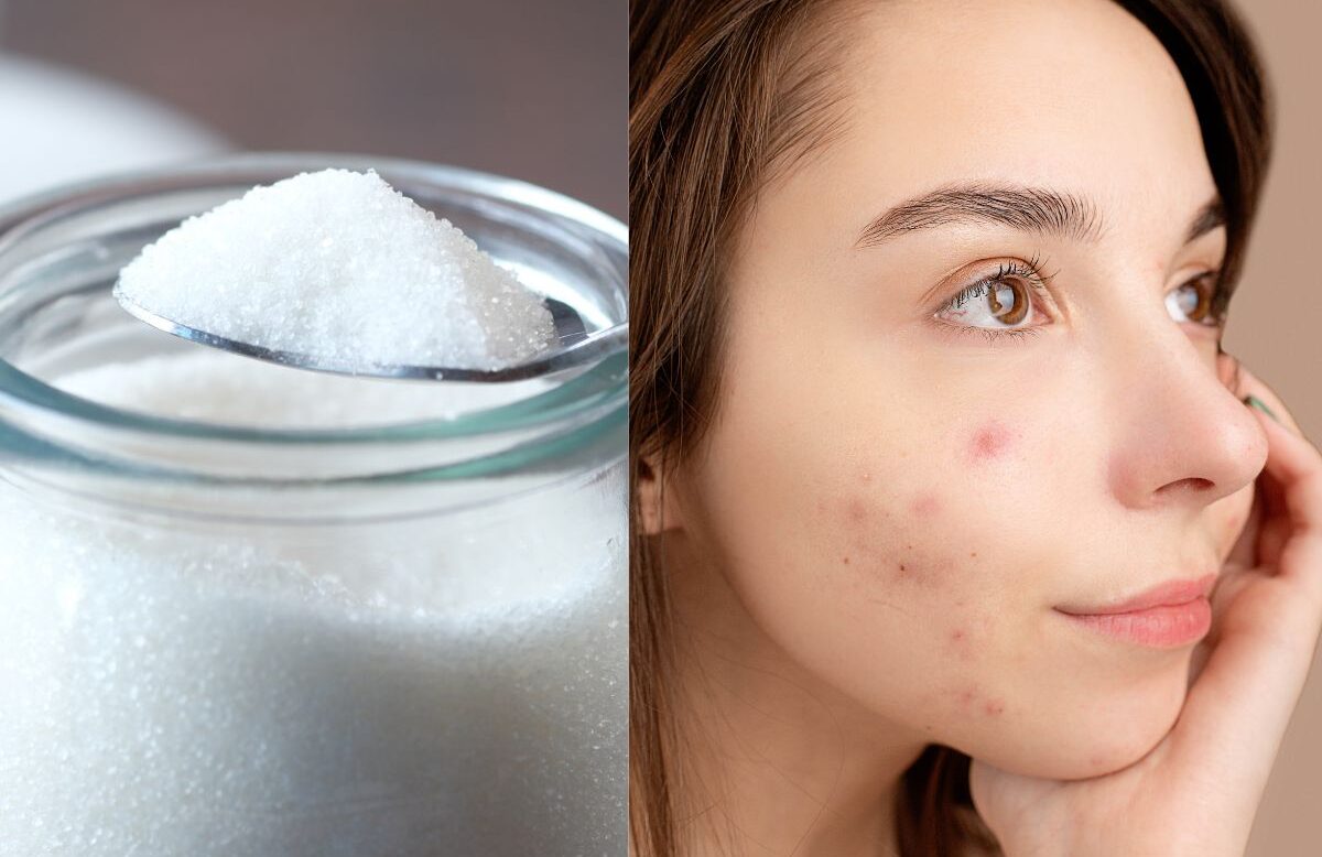 Is Sugar the Real Reason Behind Your Skin’s Breakouts, Inflammation ...