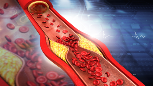 Daily Habits to Prevent Heart Blockages: 7 Ways to Keep Your Arteries ...